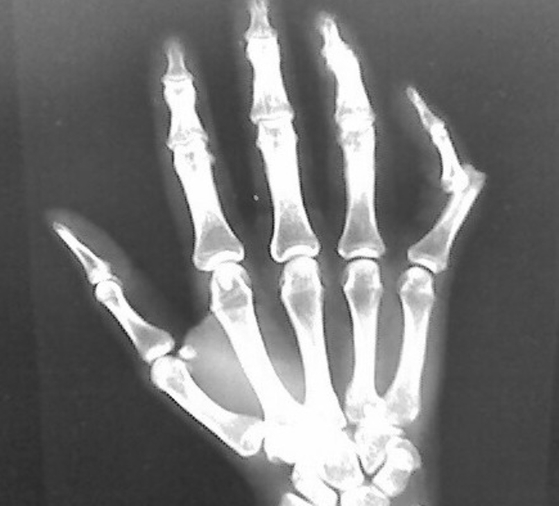 Achy Bones? You Can Relieve And Prevent Joint Pain With These Simple ...
